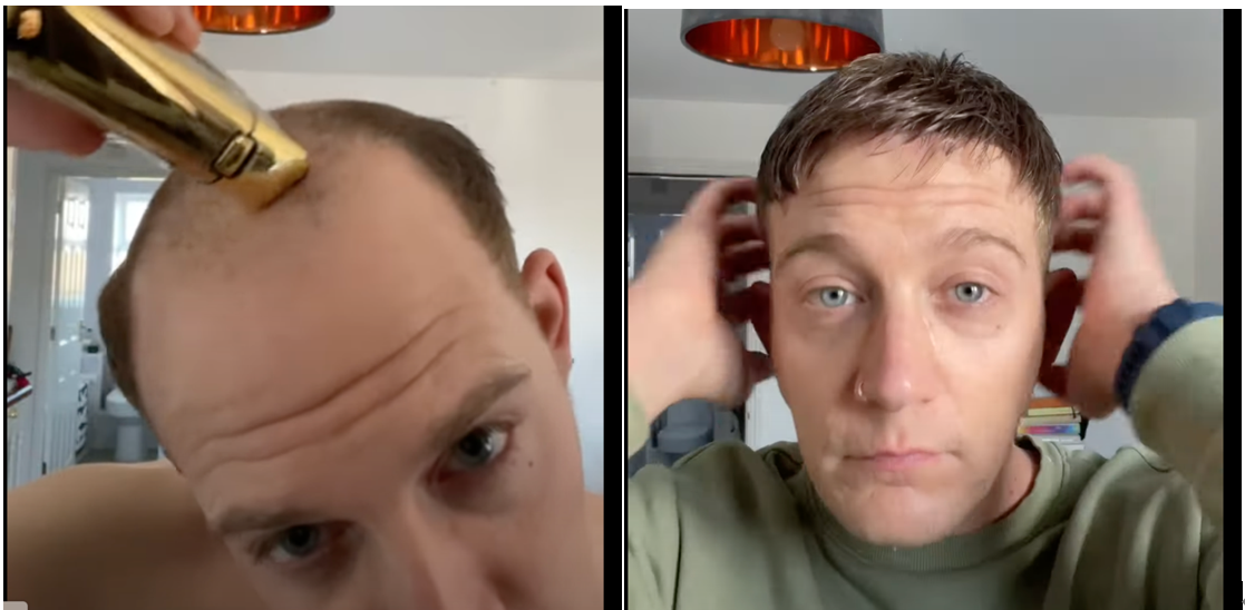 My One Regret from the First Year of Wearing a Hair System – Lavivid Hair