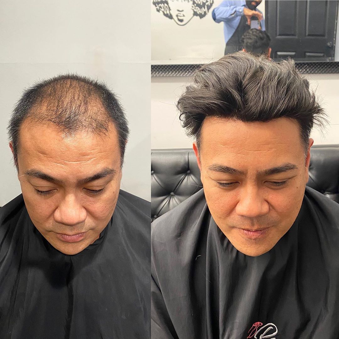 How to Treat with the Hair Loss Problems? – Lavivid Hair