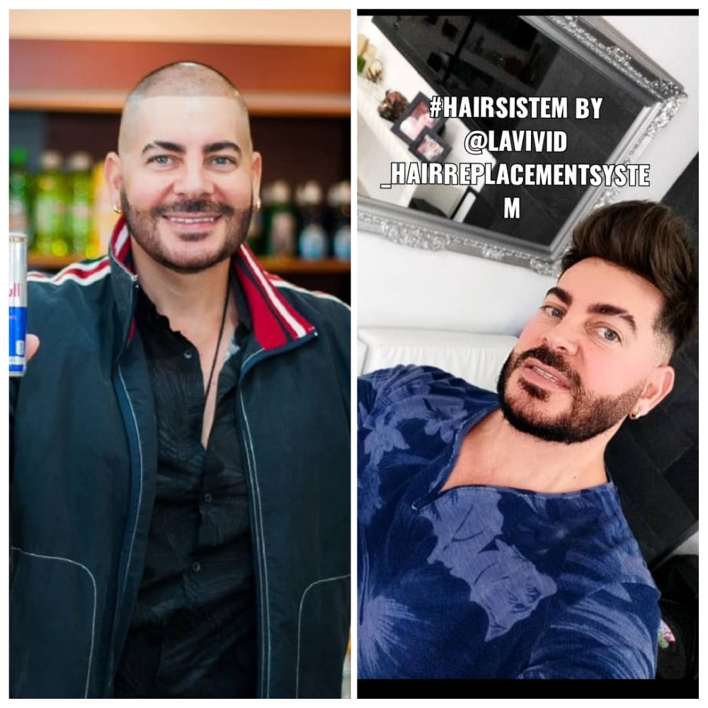 Things You Need to Know About Men's Non Surgical Hair Replacement ...