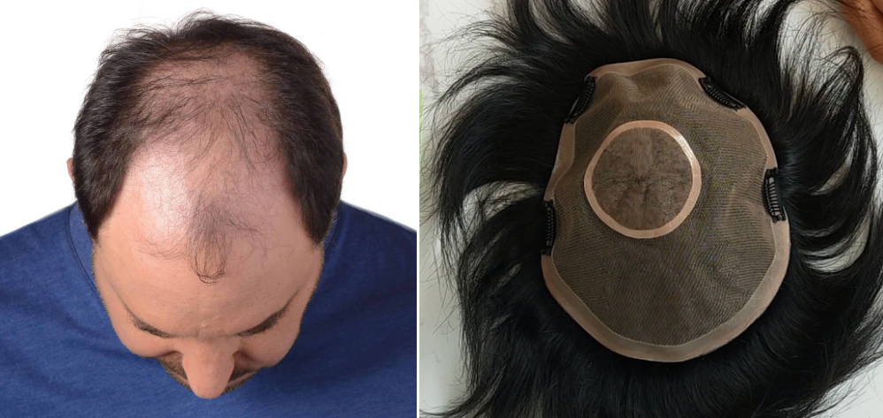 The Hair Loss Pattern that A Clip-in Hair Piece for – Lavivid Hair