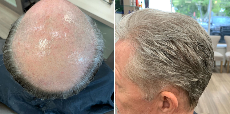 What's the Causes of Male Pattern Baldness and How to Deal with It ...