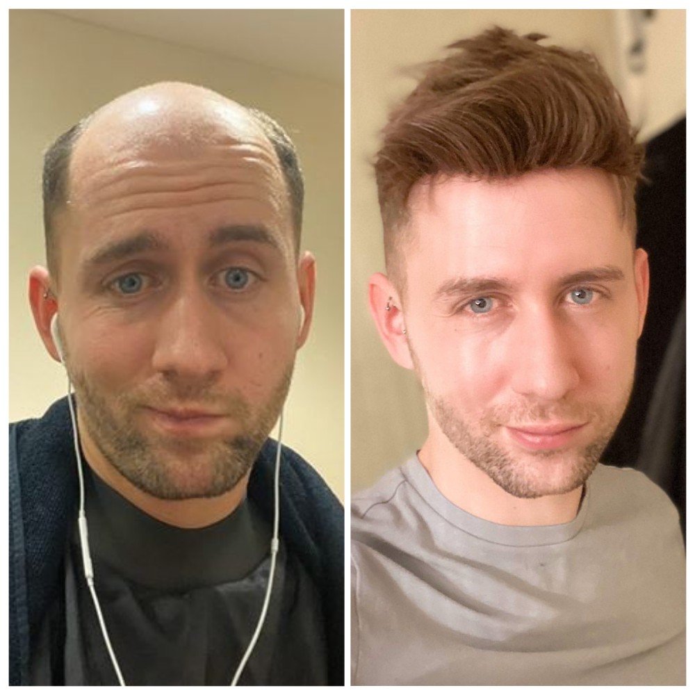 The Way to Treat Hair Loss Front of Head Male Issue – Lavivid Hair