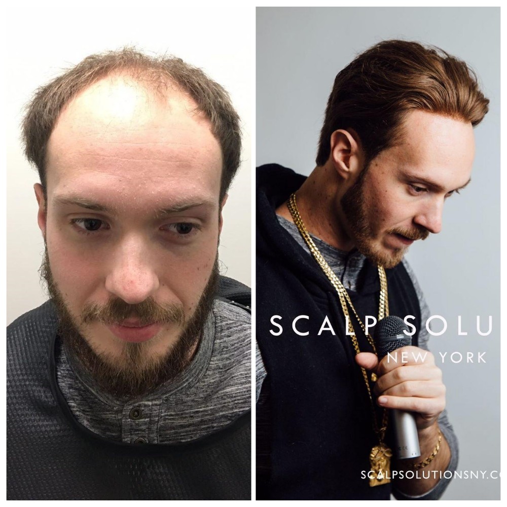 How Do Partial Hairpiece Work for the Hair Loss? – Lavivid Hair