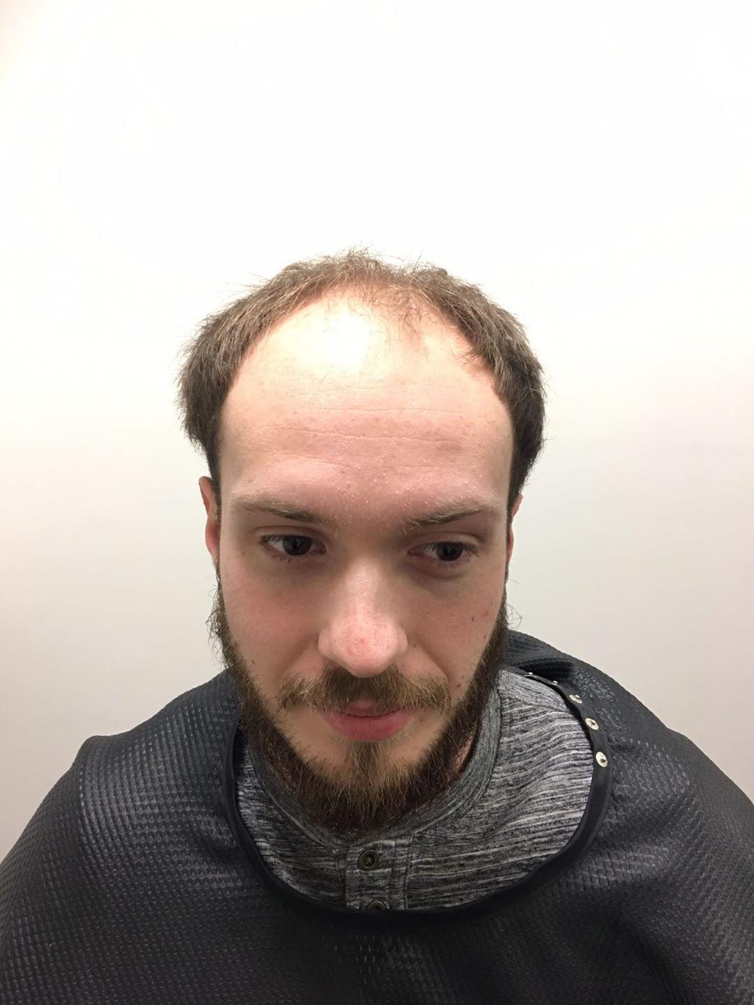 Do You Know What Causes Rapid Hair Loss Male? – Lavivid Hair