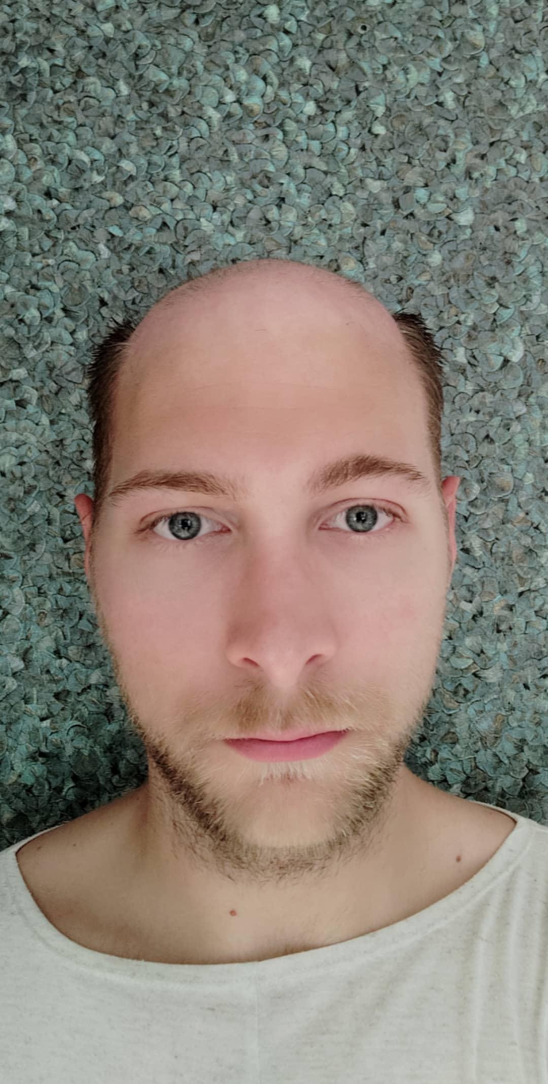 The Guide to Treat with Thinning Crown Male – Lavivid Hair