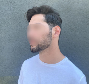 What's the Advantage of V-loop Technique for Skin Hair Systems ...