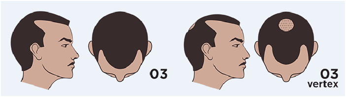 Understanding the Male Pattern Hair Loss Stages – Lavivid Hair