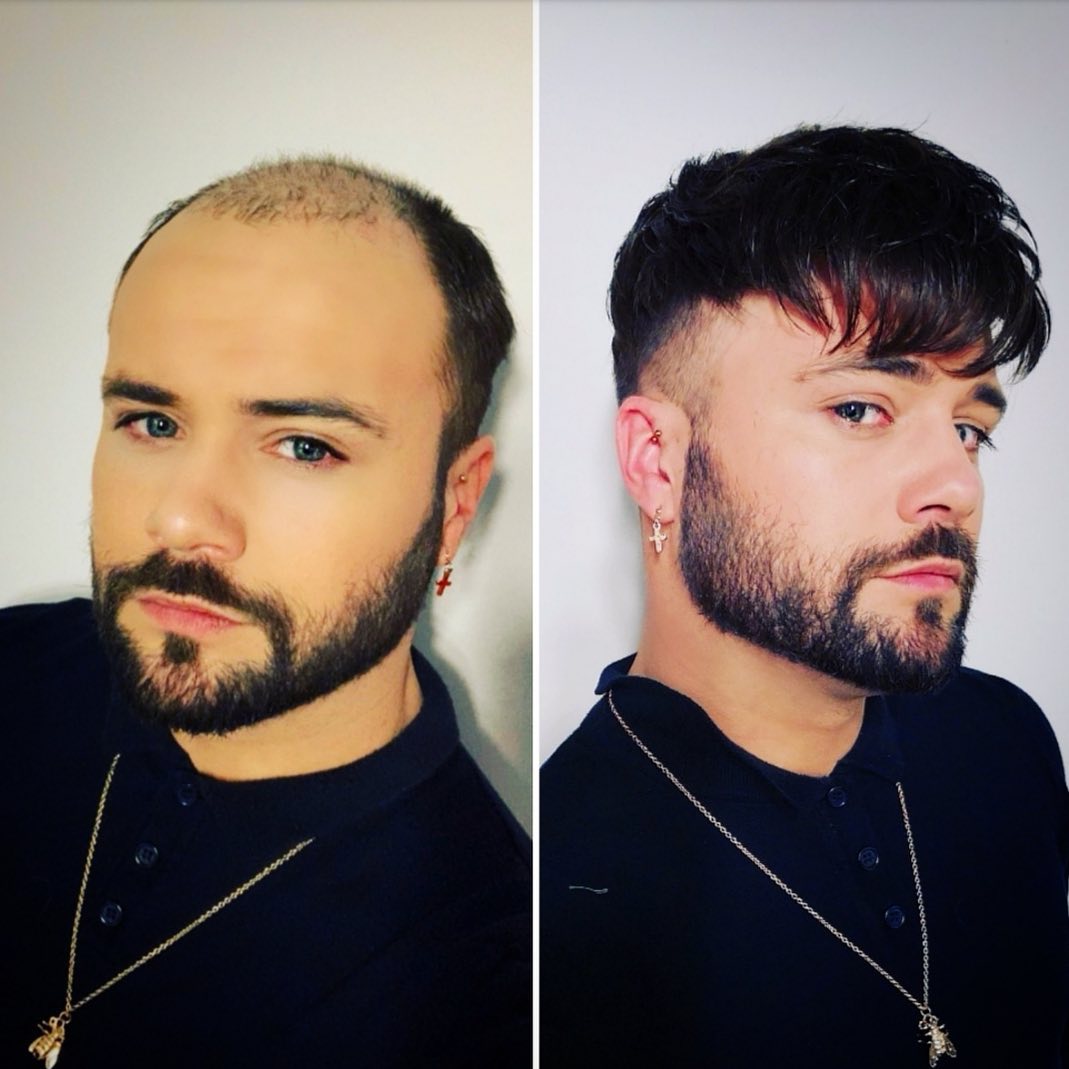 The Introduce of Home Remedies for Hair Loss in Males – Lavivid Hair