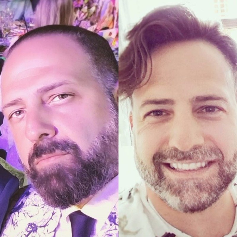 How to Solve The Problem of Early Male Pattern Baldness? – Lavivid Hair