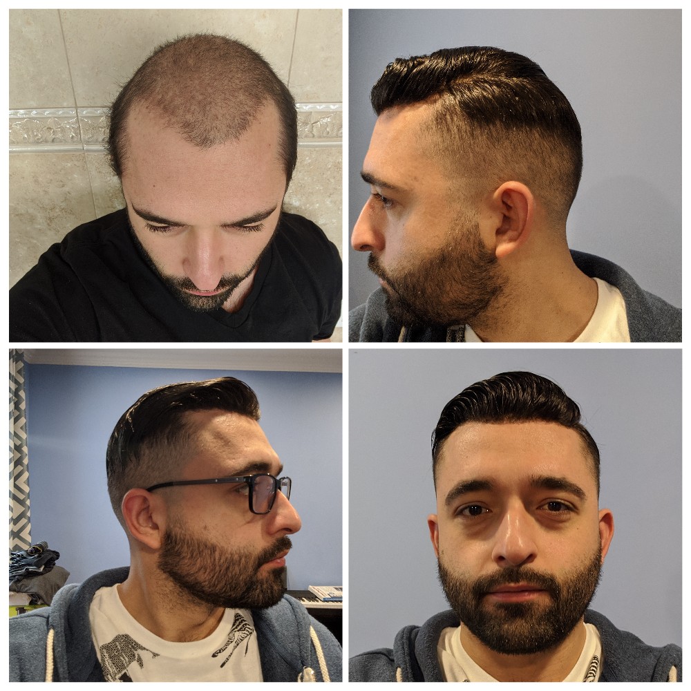 The Relationship between Smoking and Hair Loss – Lavivid Hair