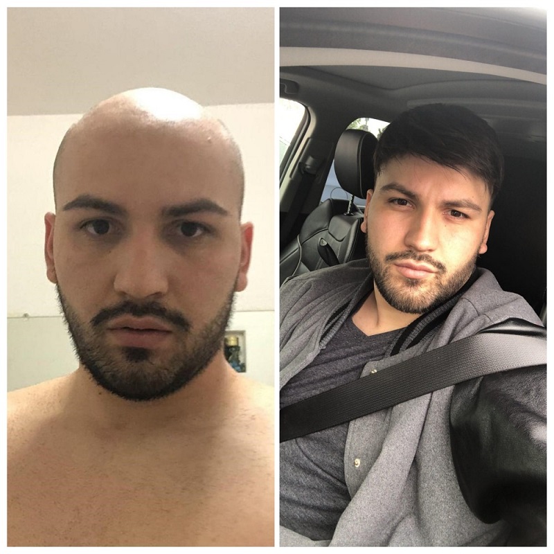 Where May I Choose The Men's Wigs for Baldness? – Lavivid Hair