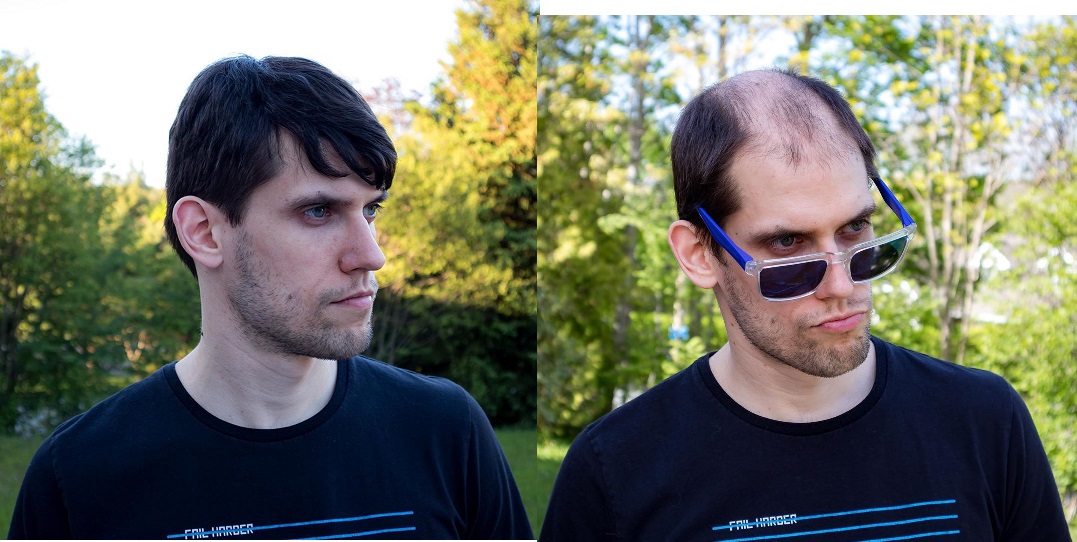 How to Prevent Male Pattern Baldness? – Lavivid Hair