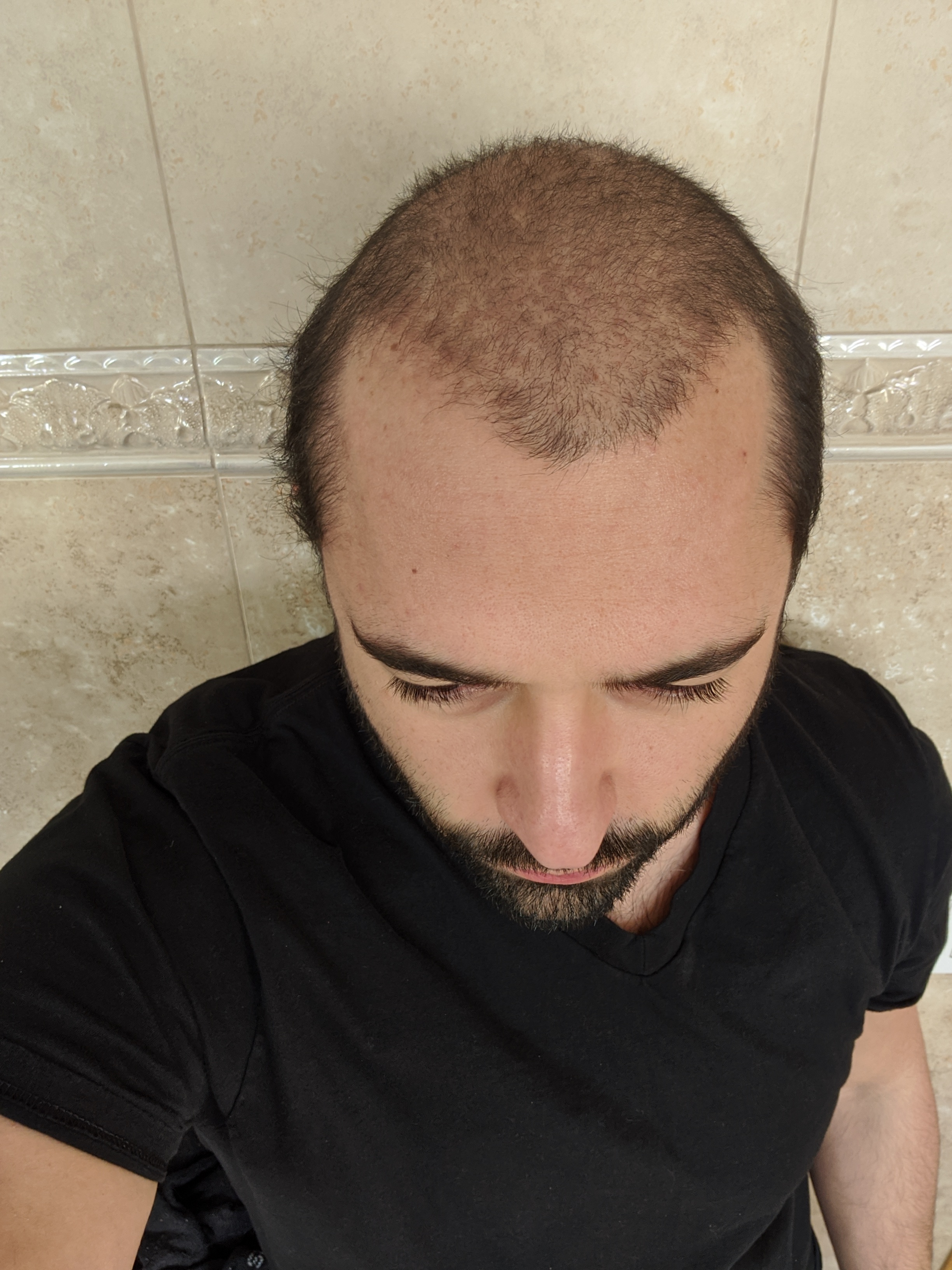 The Introduce of Hair Loss Solution Clinic – Lavivid Hair