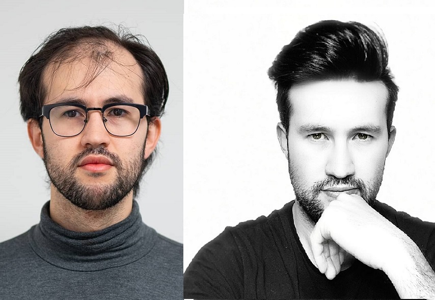 Tips on Figuring out Hair Loss Solution for Thyroid Patients – Lavivid Hair