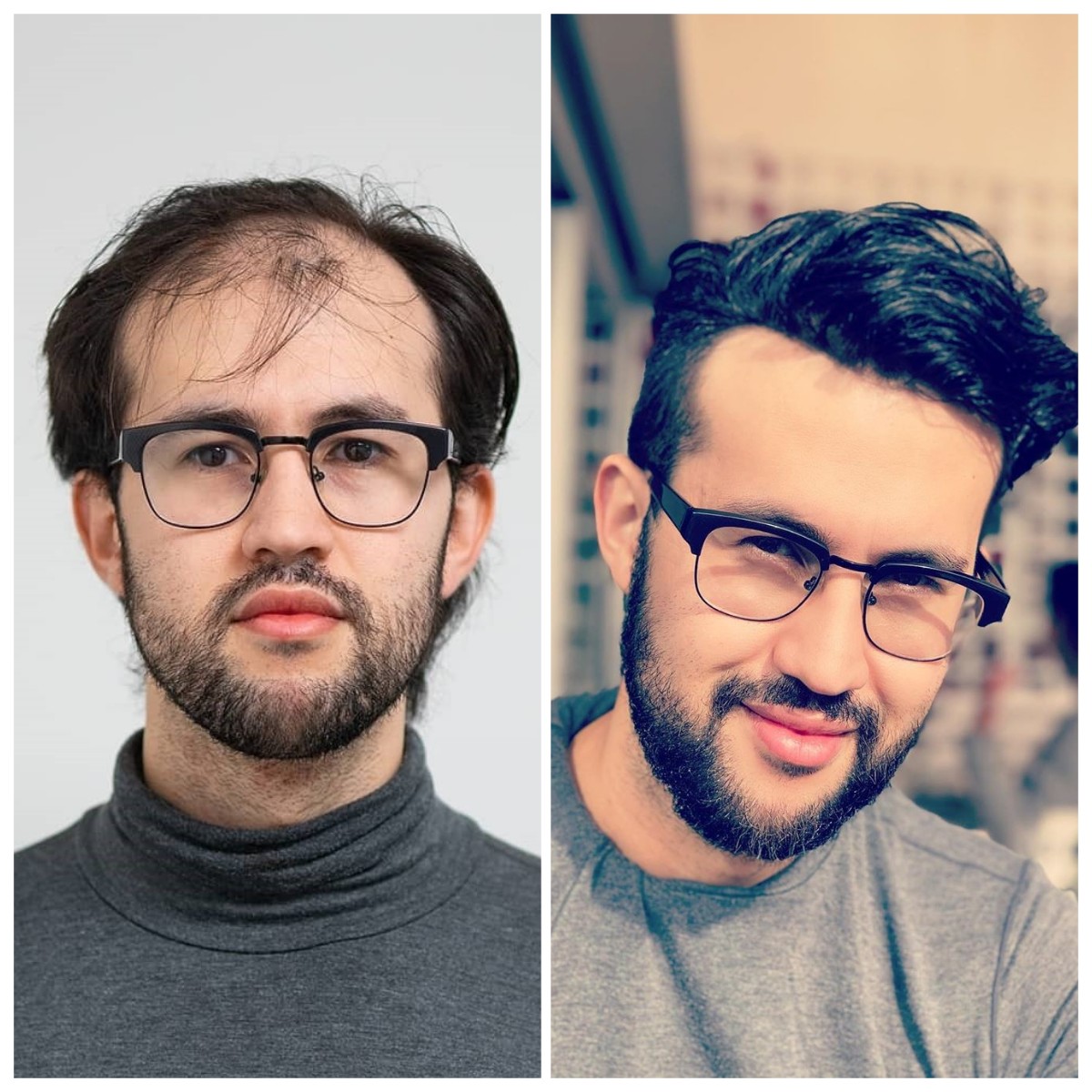 The Introduction of Hair Loss Treatment Canada – Lavivid Hair