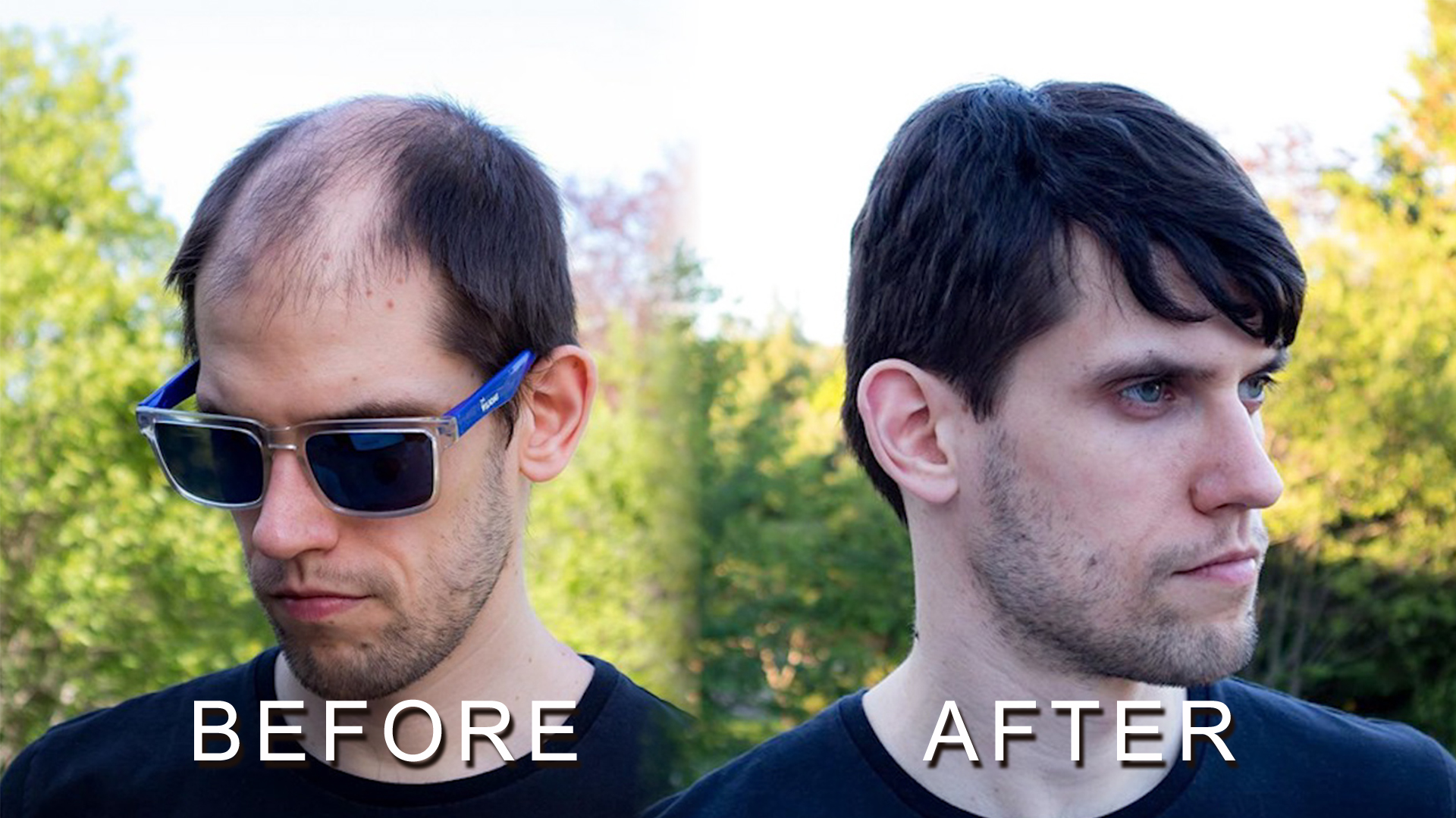 How to Maintain the Hair Loss Treatment Glasgow? – Lavivid Hair