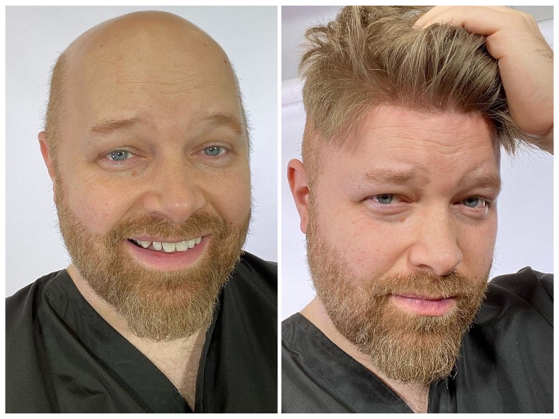 Some Tips on Learning How to Cure Hair Loss Male – Lavivid Hair