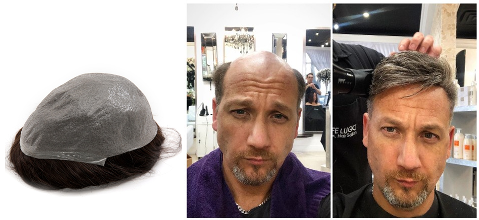 How to Cure Male Pattern Baldness? – Lavivid Hair