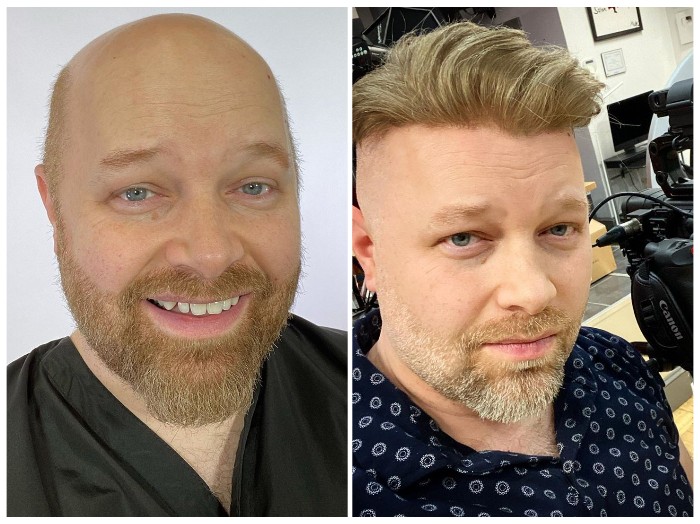 How to Choose the Best Rated Hair Loss Treatment for Men? – Lavivid Hair