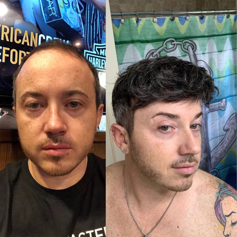 What Would Affect the Hair Transformation Cost? – Lavivid Hair