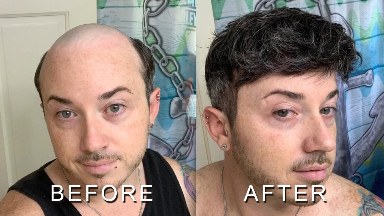 How Does Non Surgical Hair Replacement Affect Life? – Lavivid Hair